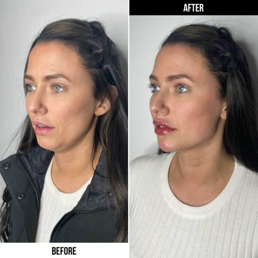 Facial Balancing Before And After