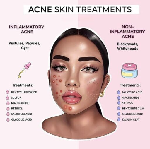 Acne Skin Treatments (Chart)
