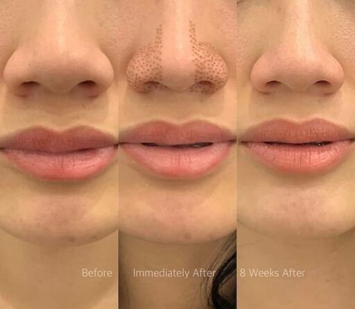 Full Face Fibroblast Before And After