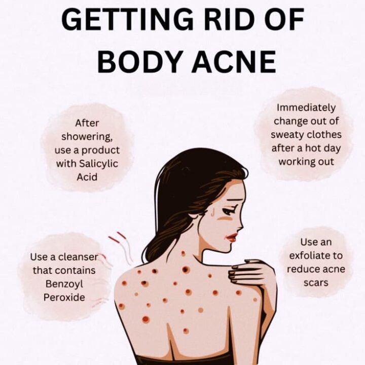 How To Get Rid Of Body Acne (Infographic)