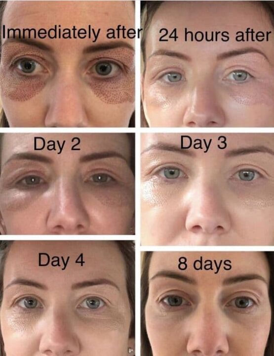 Full Face Fibroblast Before And After