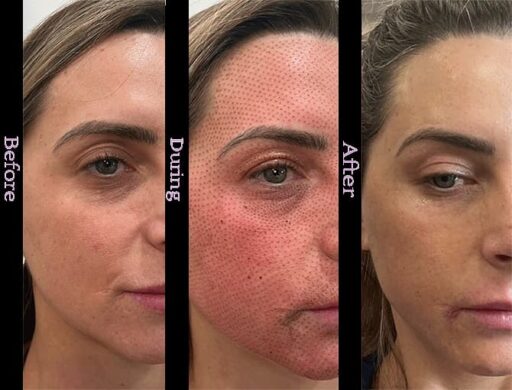 Full Face Fibroblast Before And After