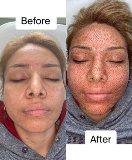 Full Face Fibroblast Before And After