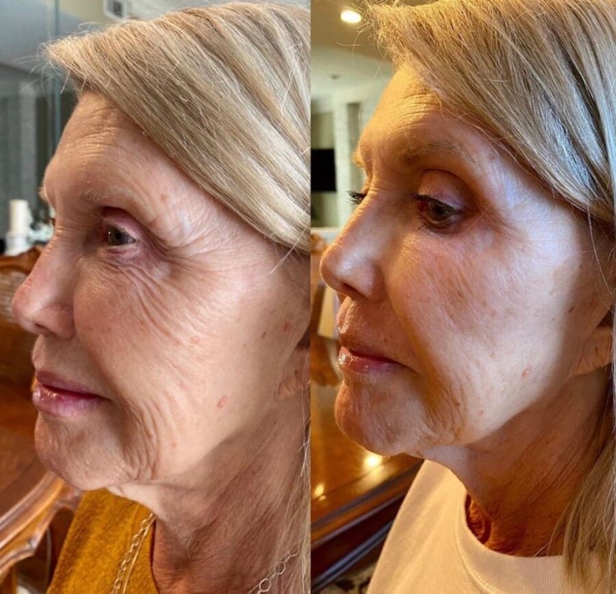 Full Face Fibroblast Before And After Full Face Fibroblast Before And After
