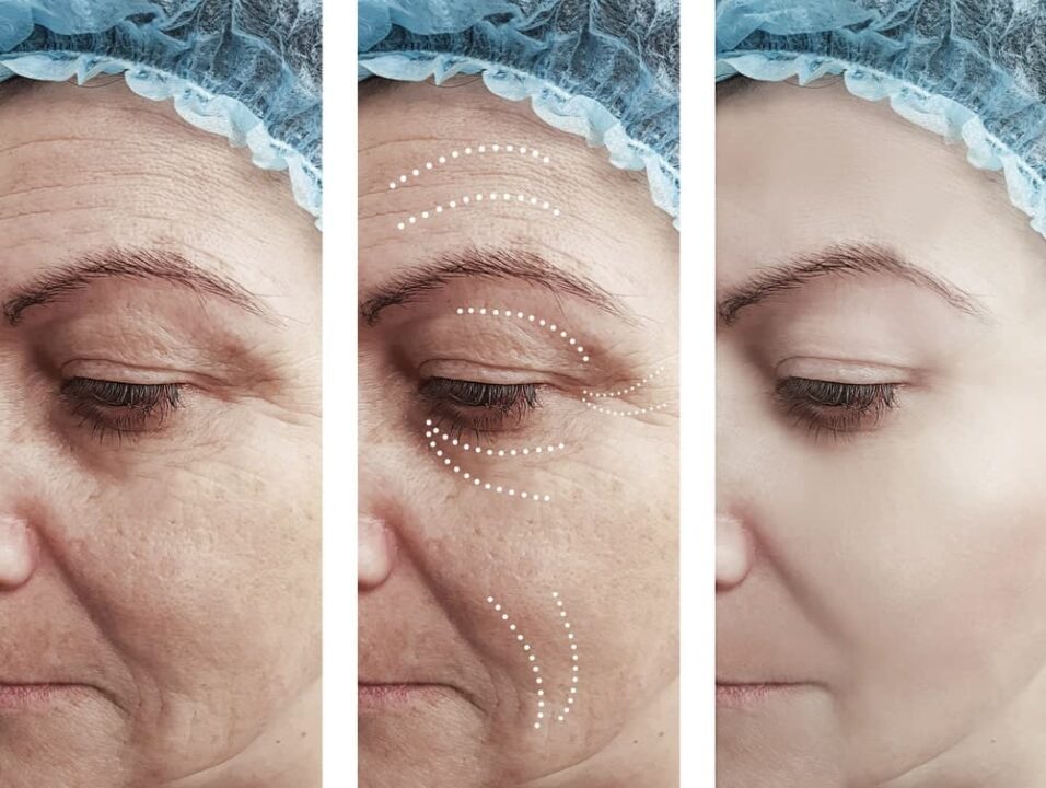Full Face Fibroblast Before And After