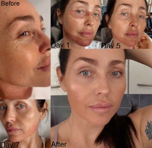 Full Face Fibroblast Before And After