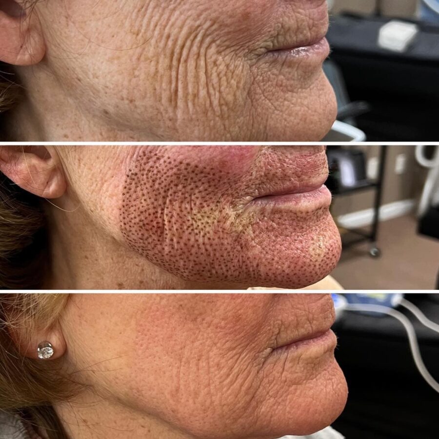 Full Face Fibroblast Before And After