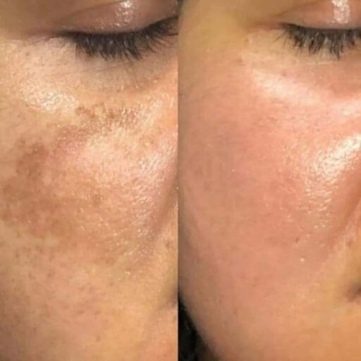 Full Face Fibroblast Before And After
