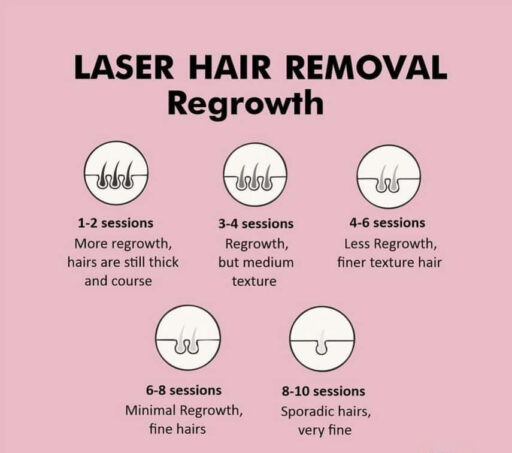 Laser Hair Removal Regrowth Journey (Infographic)