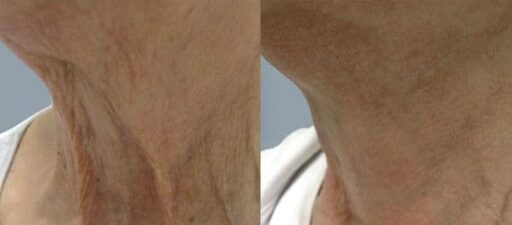Full Face Fibroblast Before And After