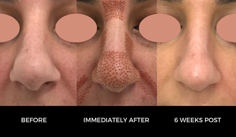 Full Face Fibroblast Before And After