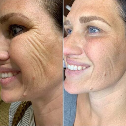 Full Face Fibroblast Before And After