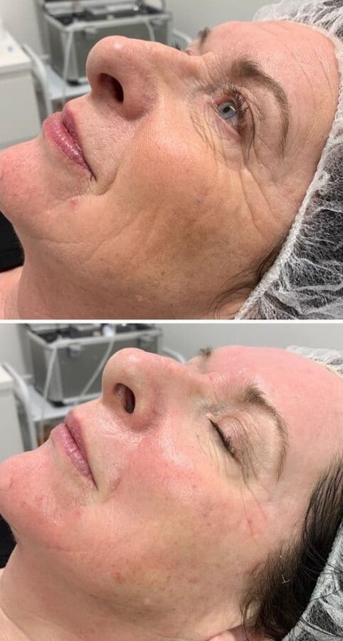 Full Face Fibroblast Before And After
