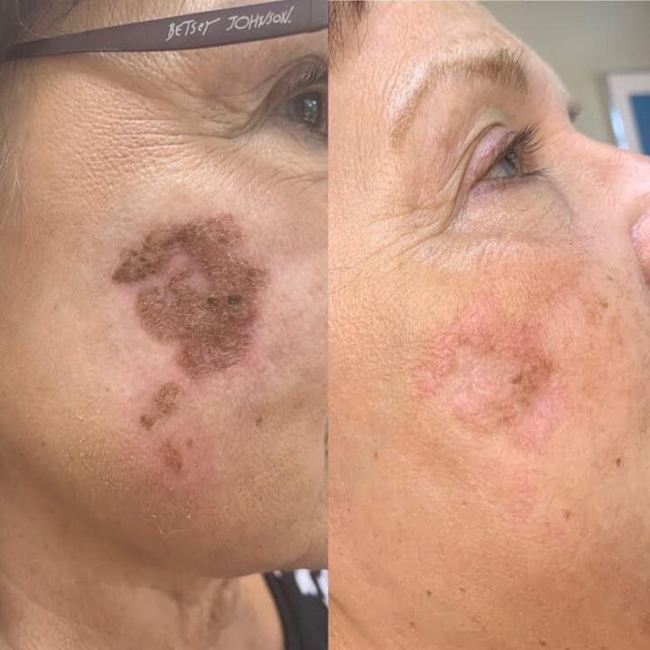 Full Face Fibroblast Before And After