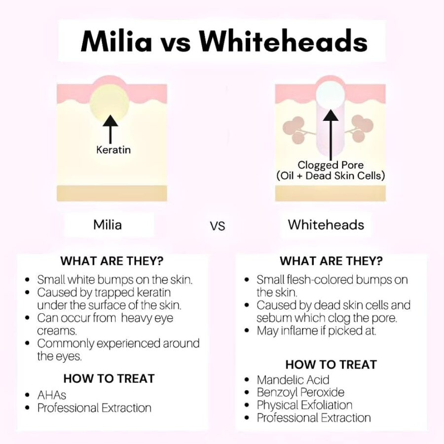 Difference Between Milia And Whiteheads (Chart)