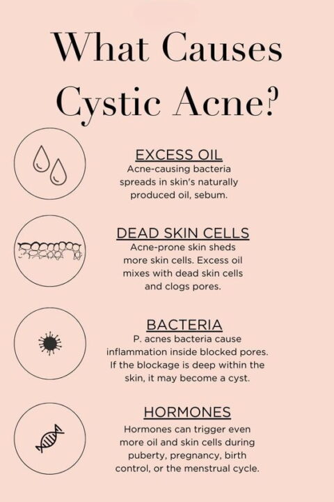 What Causes Cystic Acne? (InfoVis)