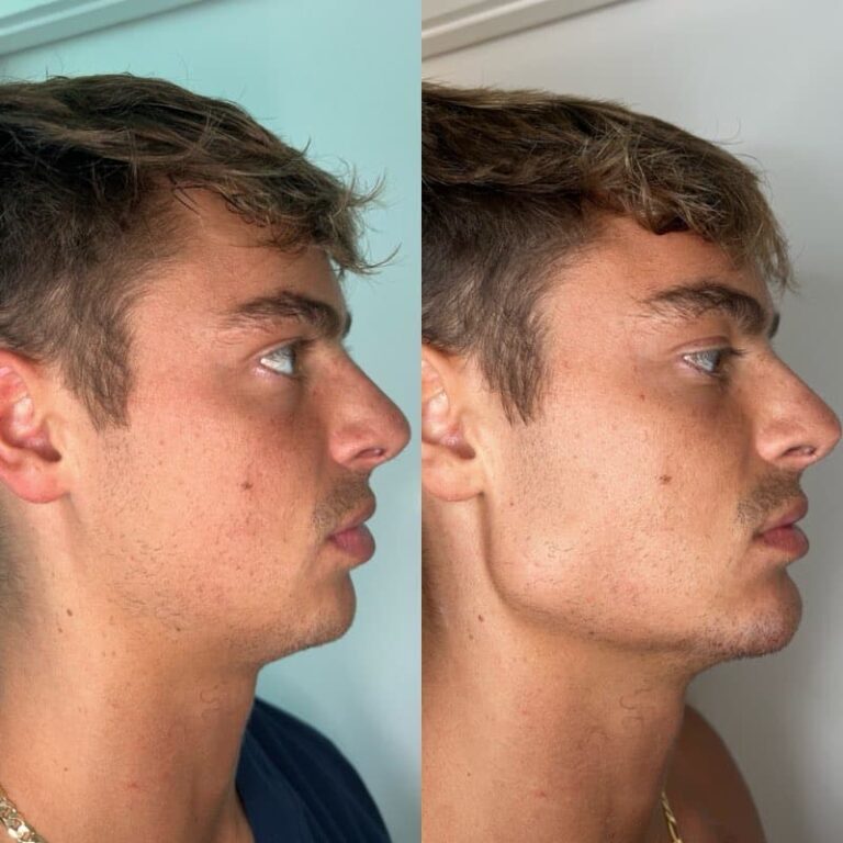 Facial Balancing Before And After
