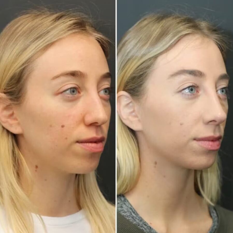Facial Balancing Before And After