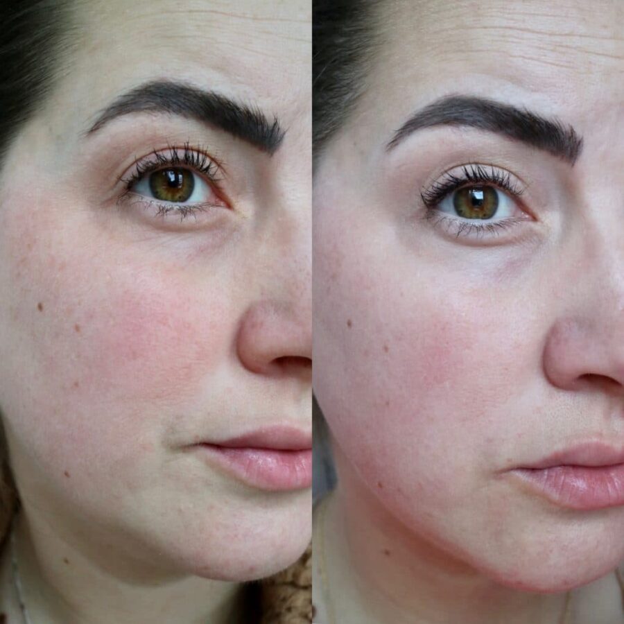 Olay Retinol 24 Before And After Pictures