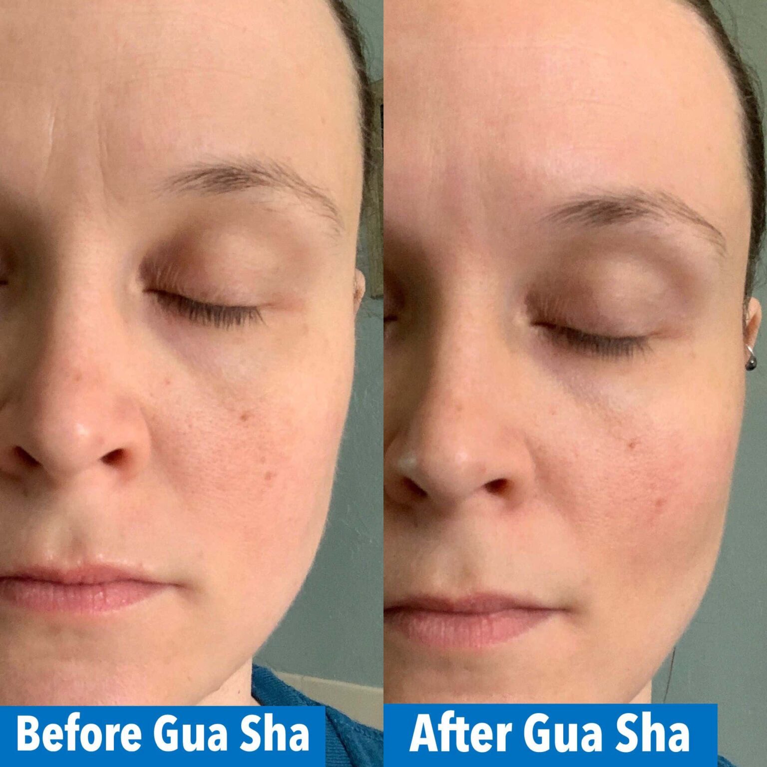 Gua Sha Before And After Photos Jade Quartz And More