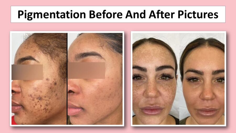 Pigmentation Before And After Pictures (What to Expect)