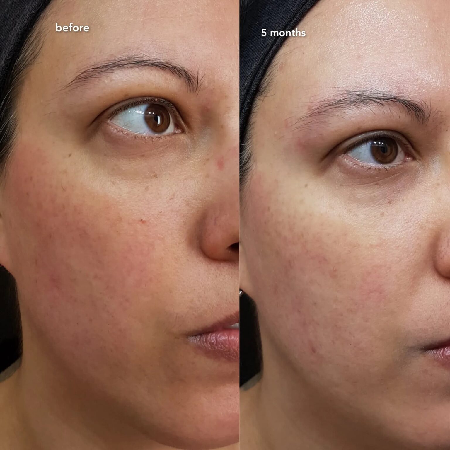 Face Before And After Vitamin C Serum Pictures