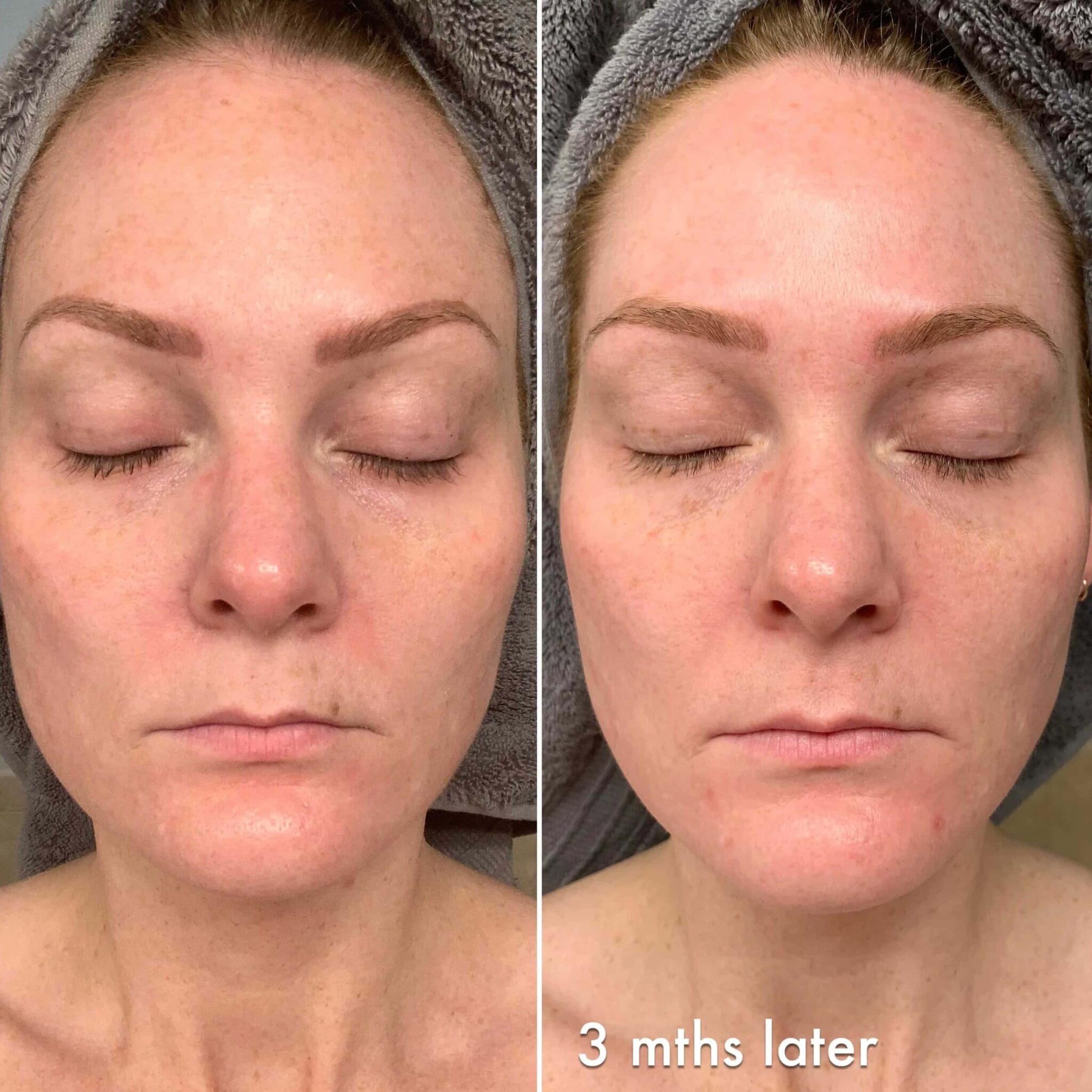 Face Before And After Vitamin C Serum Pictures