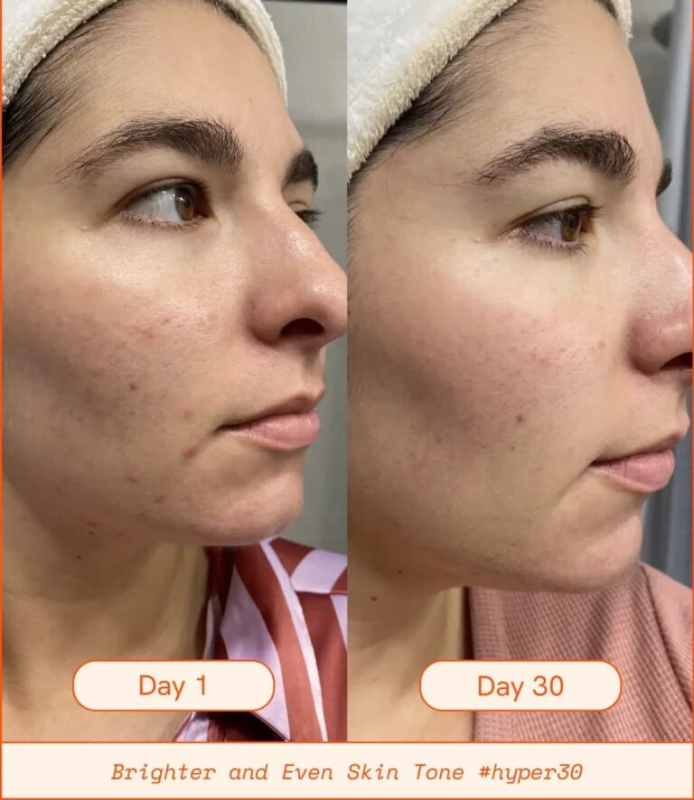Face Before And After Vitamin C Serum Pictures